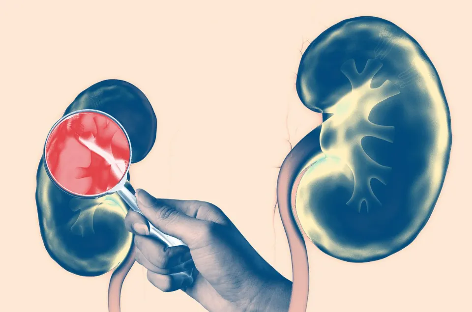 Beyond the Basics: Uncovering Lesser-Known Effects of Kidney Disease ... Beyond the Basics: Uncovering Lesser-Known Effects of Kidney Disease ...